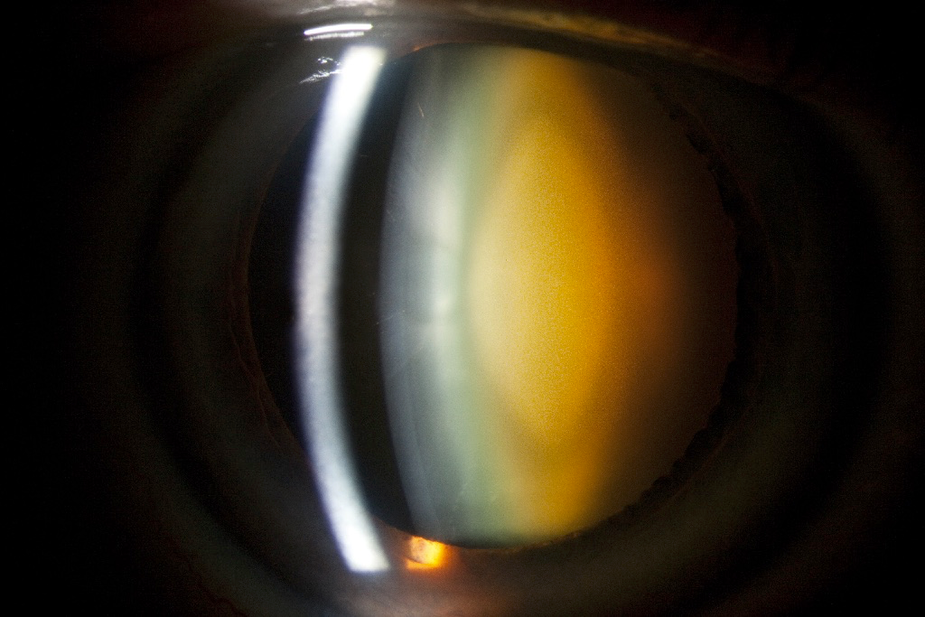 Nuclear Cataract